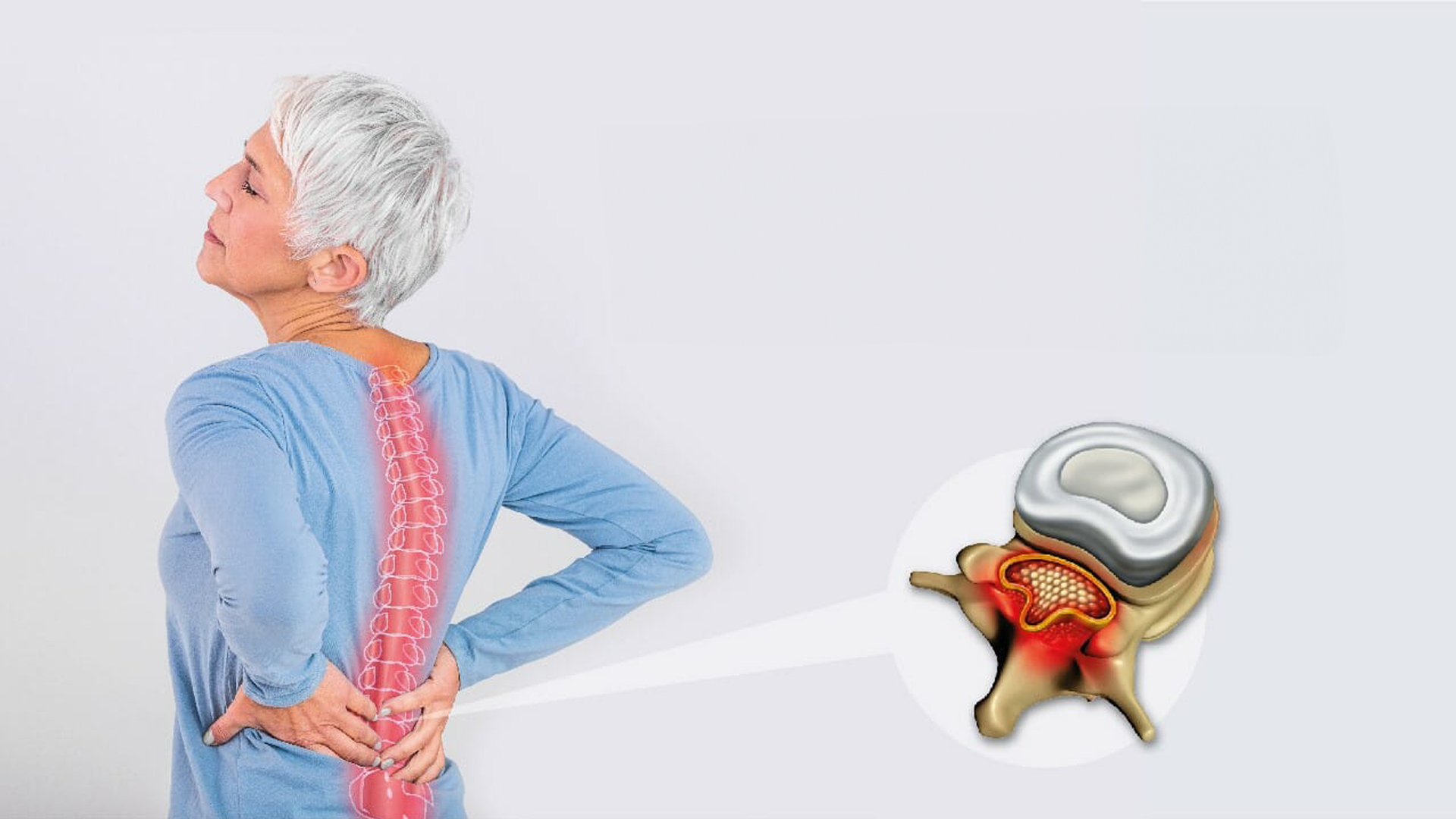 Endoscopic surgery for the treatment of spinal stenosis with the PSLD ...